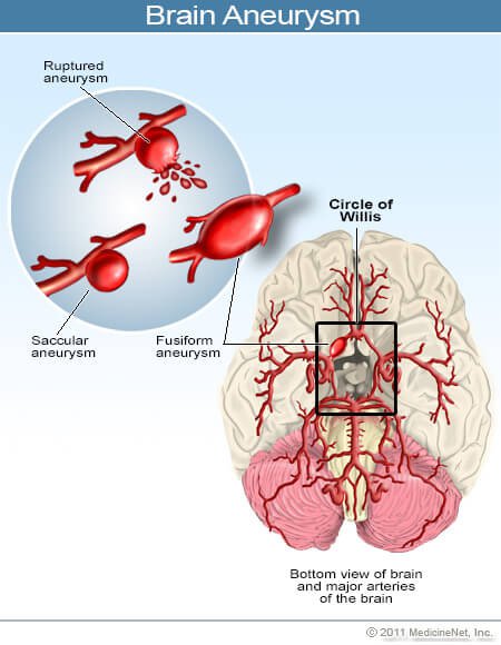 A brain aneurysm- “the ticking time bomb” - Kaieteur News