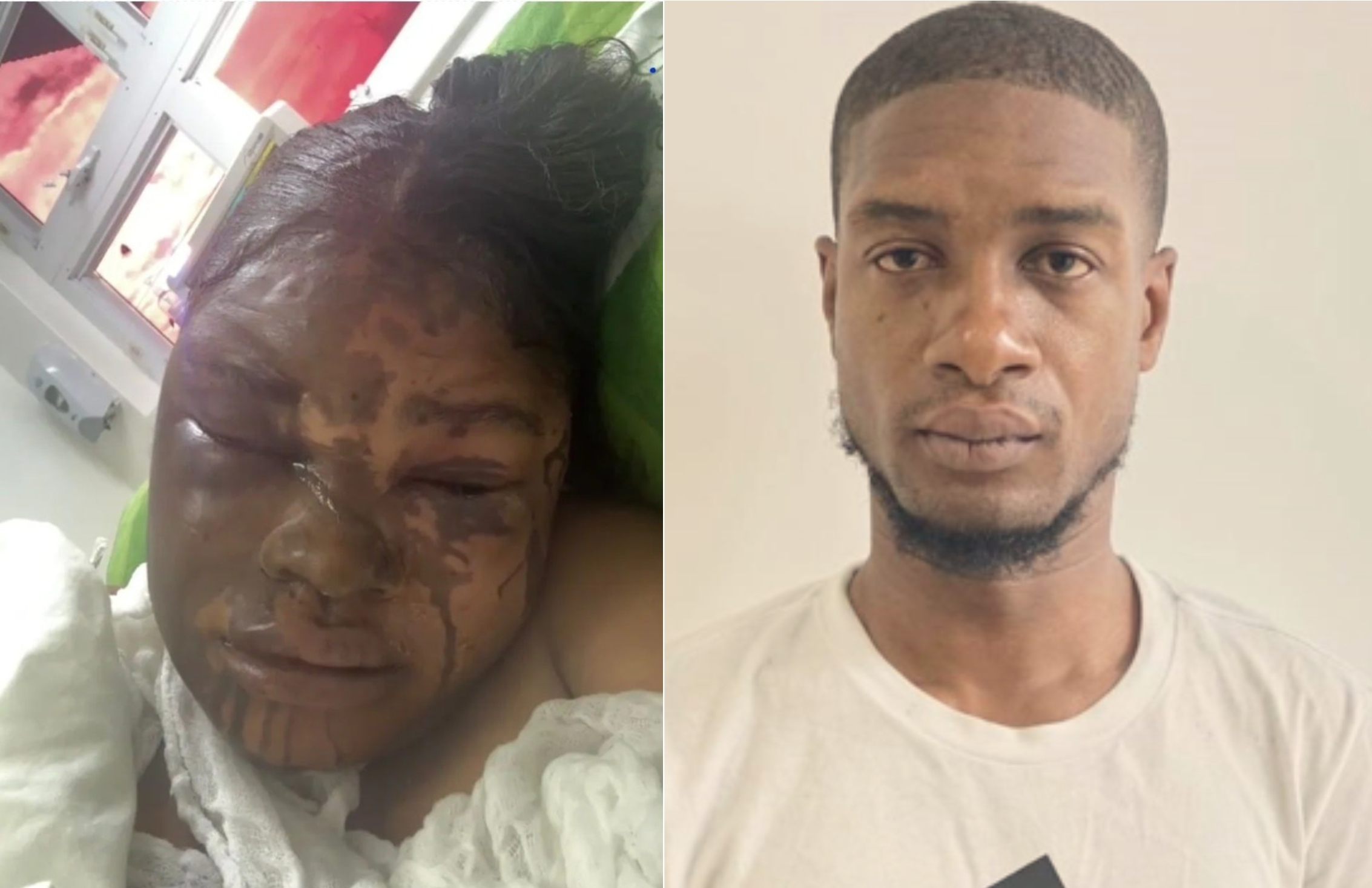 Cops fume as acid attacker walks on bail - Kaieteur News